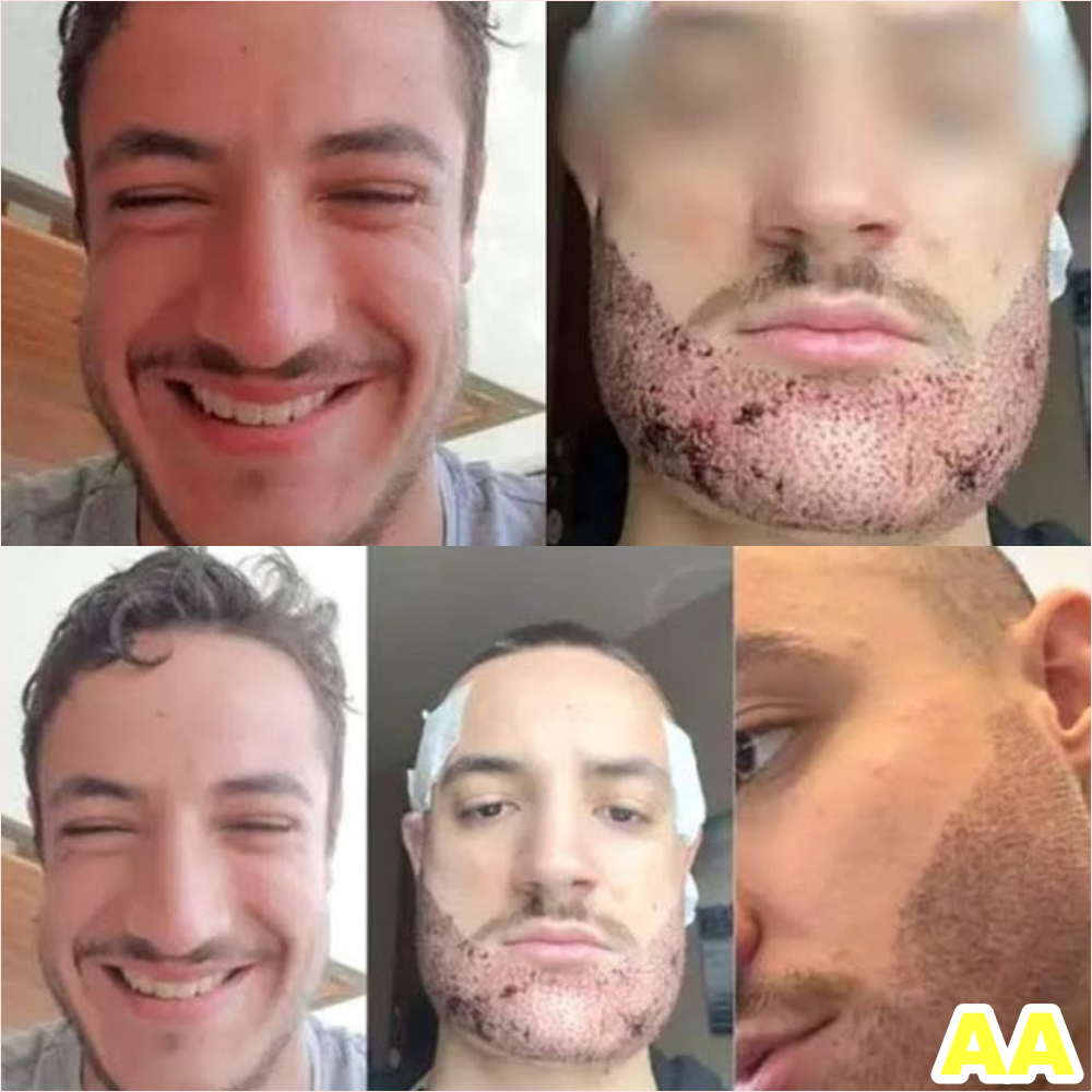 "24-Year-Old Student's Shocking End: How a Failed Beard Transplant Led ...